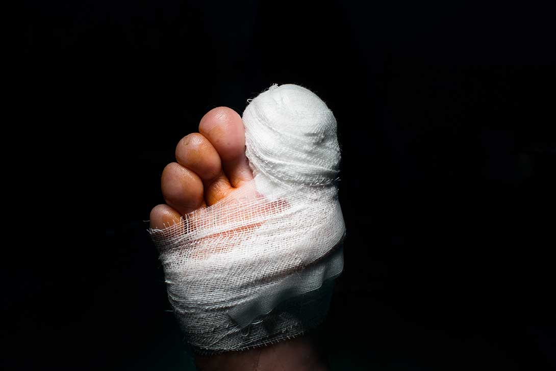Toe Pressure and TBI: Assessing Critical Limb Ischemia Beyond ABI - SOT ...