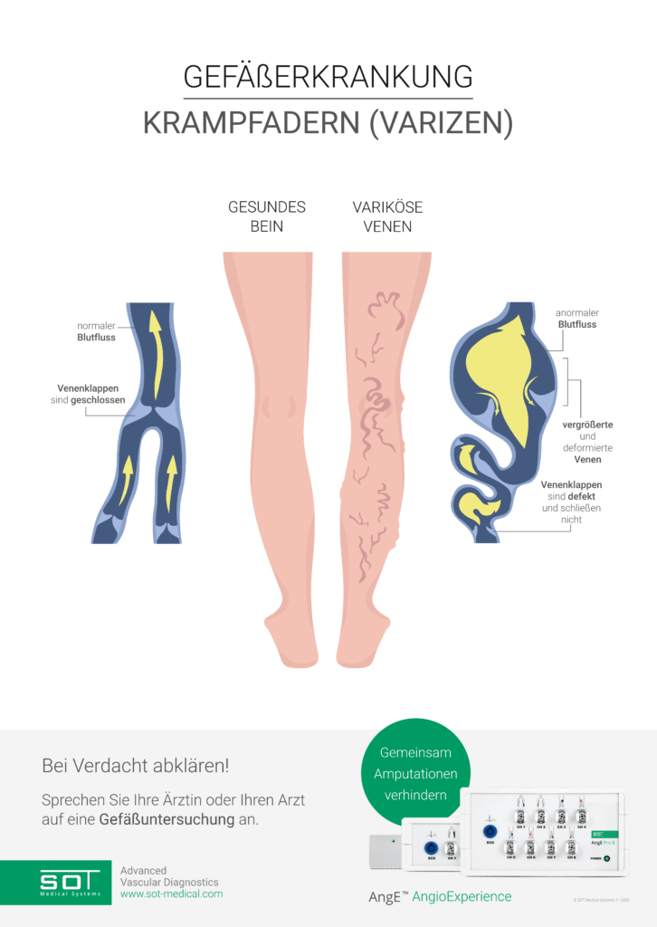 Infografik erklärt: Krampfadern (Varizen) - SOT Medical Systems